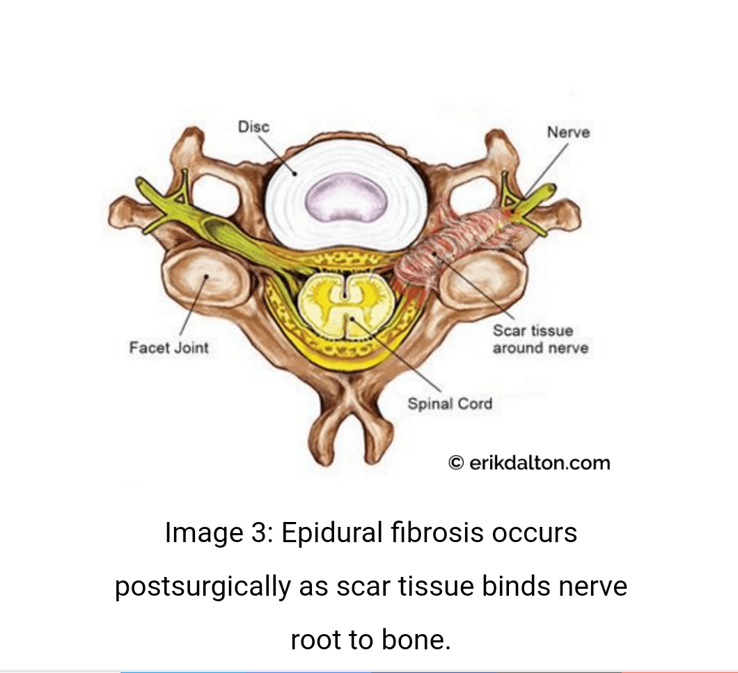 Epidural Fibrosis - iPain Foundation Condition Information