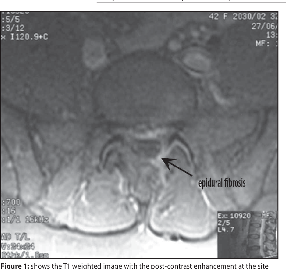 Epidural Fibrosis - iPain Foundation Condition Information