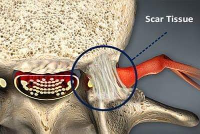 Epidural Fibrosis - iPain Foundation Condition Information